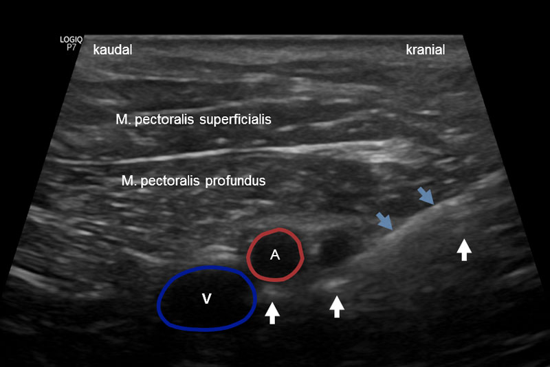 Plexus-Brachialis-Block